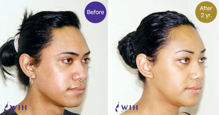 Facial Feminization Surgery (FFS) - WIH INTERNATIONAL HOSPITAL