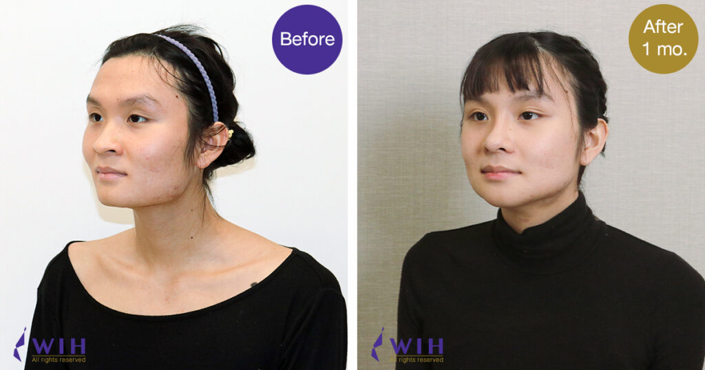 Nose Surgery Rhinoplasty - WIH INTERNATIONAL HOSPITAL