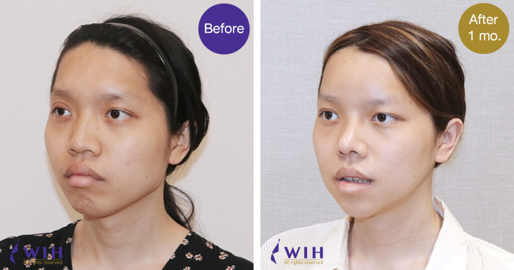 Gallery Facial Bone Surgery - WIH INTERNATIONAL HOSPITAL