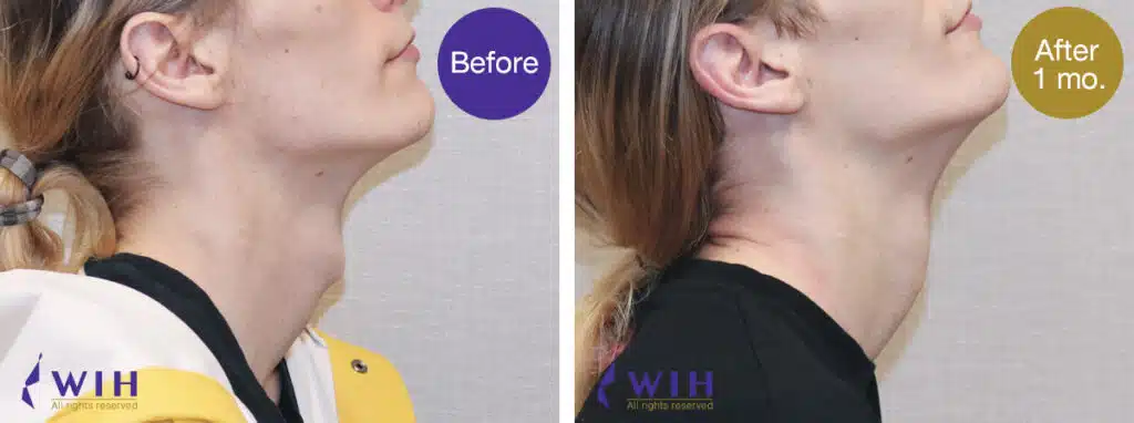 Gallery adam's apple shave before and after - WIH INTERNATIONAL HOSPITAL