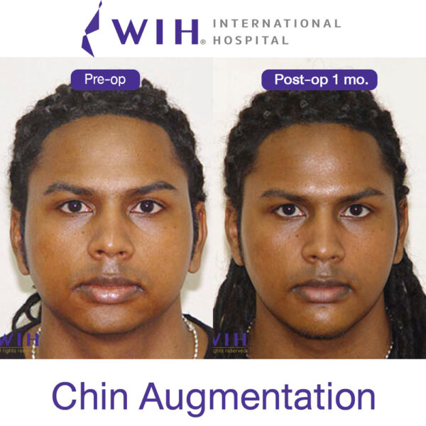 Chin Augmentation Surgery | Improve Jawline and Facial Balance