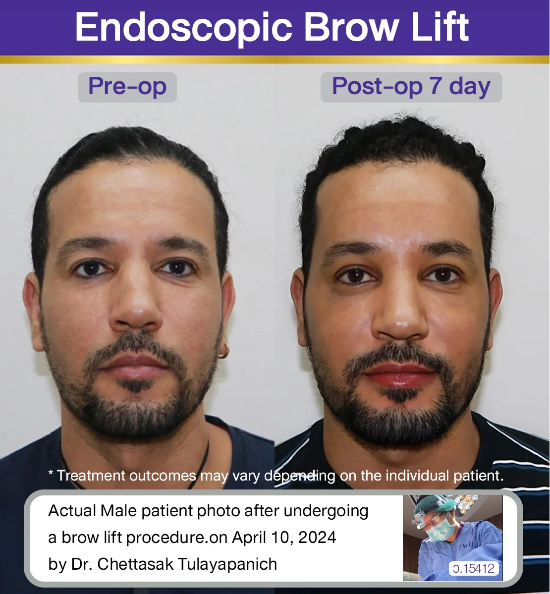 Endoscopic & Coronal Brow Lift in Bangkok