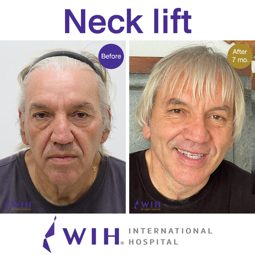 Neck lift surgery