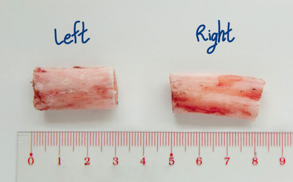 Shoulder Narrowing Surgery - WIH International Hospital
