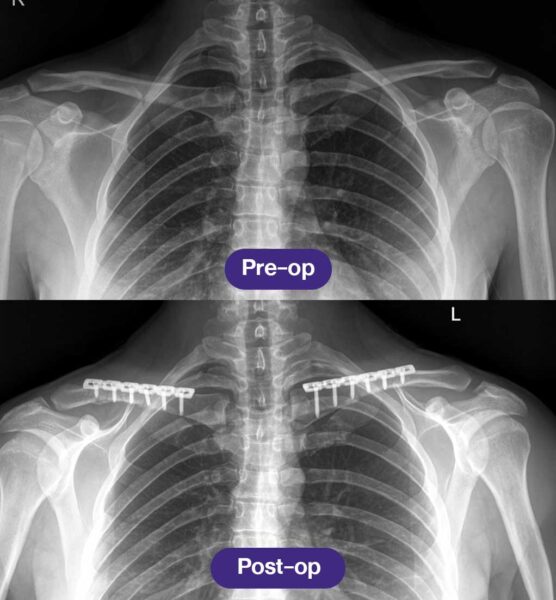 Shoulder Narrowing Surgery - WIH International Hospital